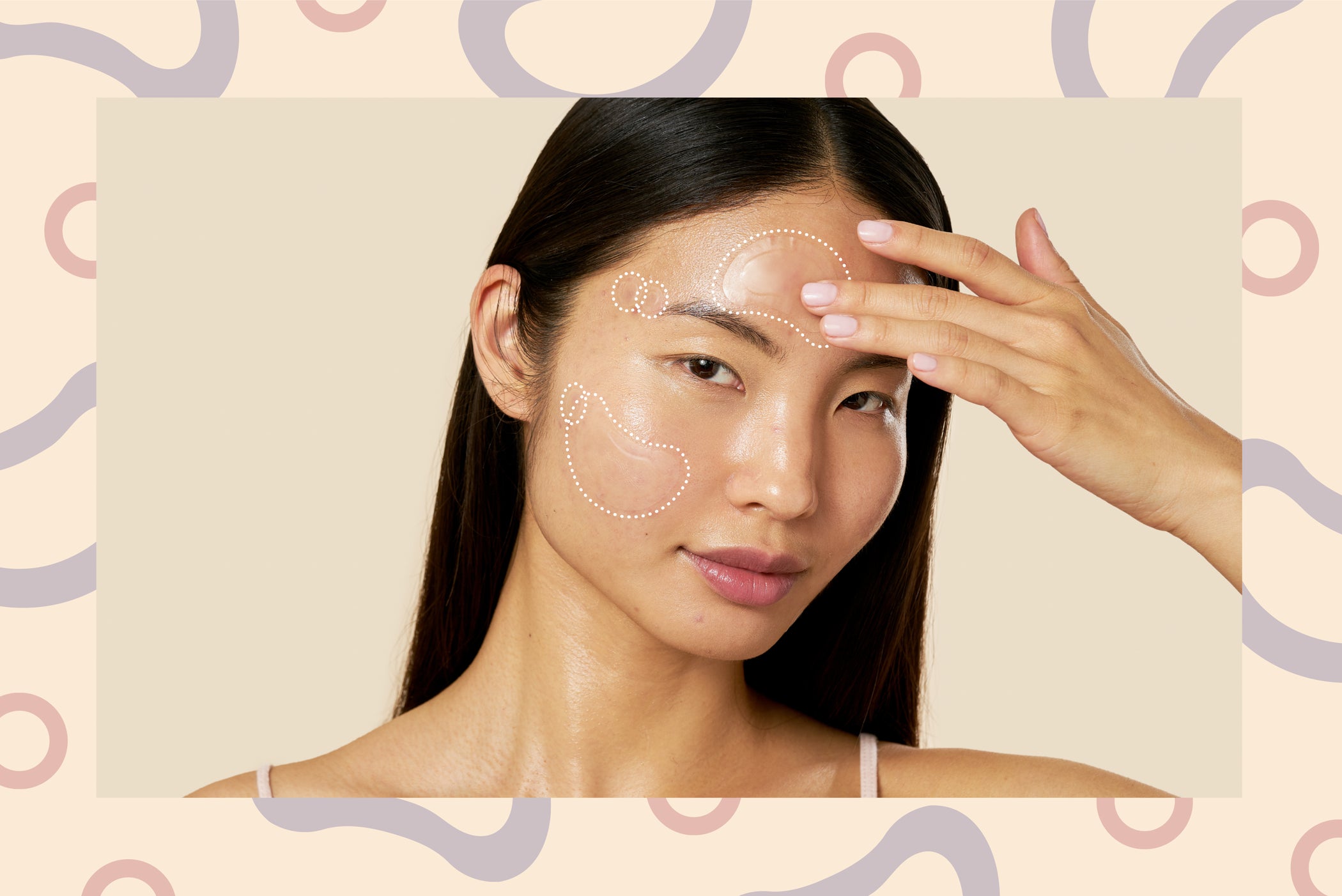 What Is Subclinical Acne? Causes & Treatments – Rael