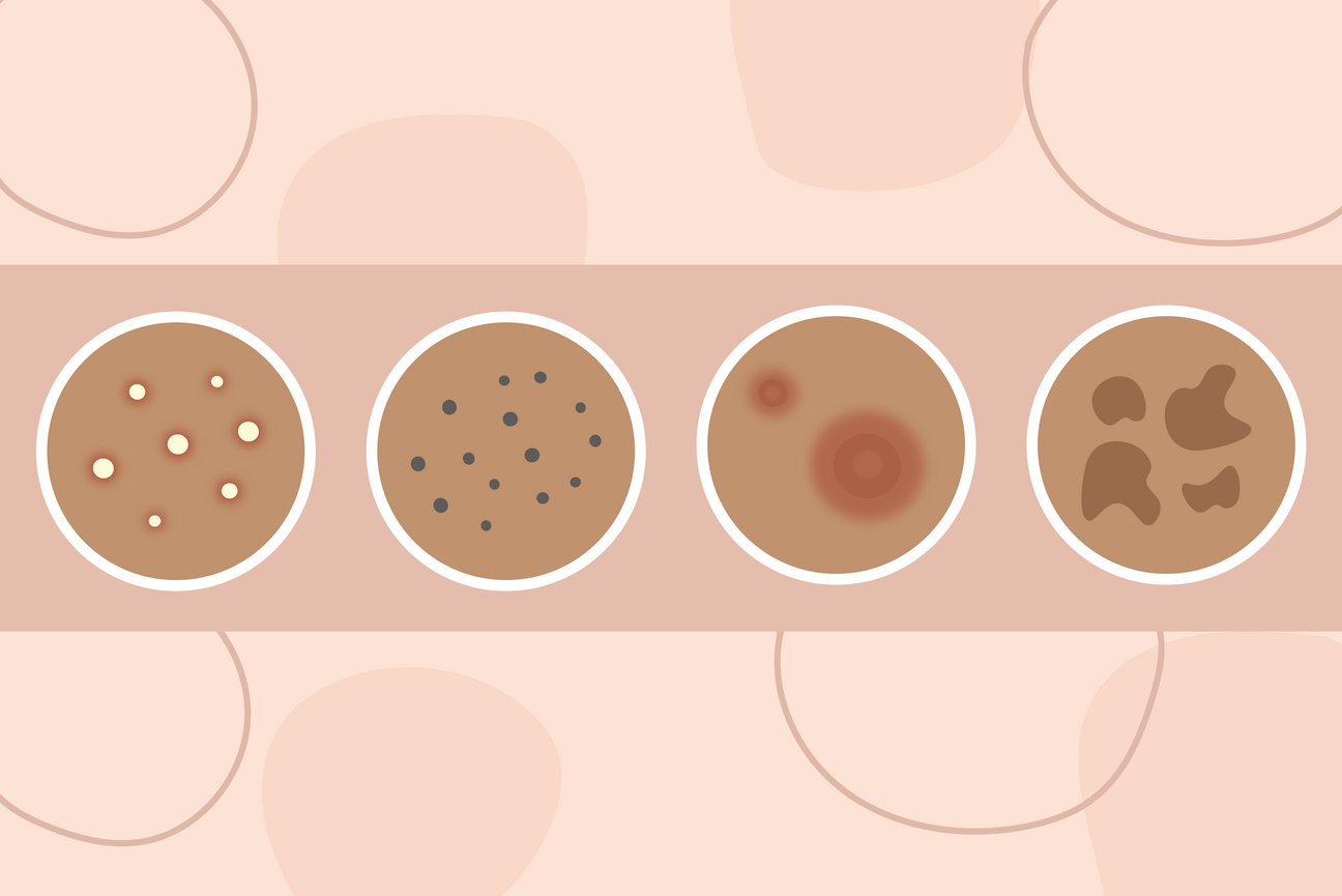 Stages of a Pimple: The Complete Guide – Rael