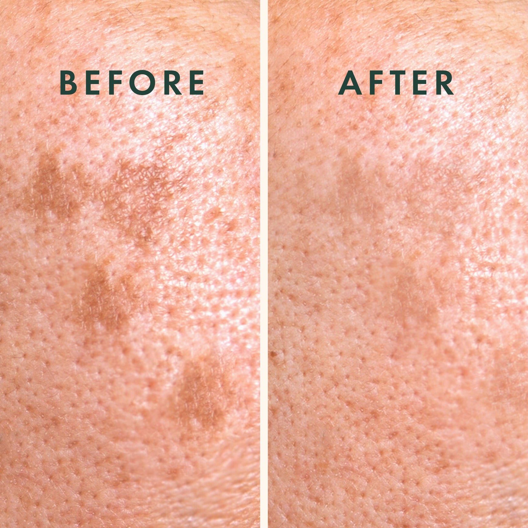 Get Rid of Acne Dark Spots | Microcrystal Dark Spot Cover | Rael